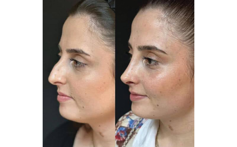 Top 10 Best Rhinoplasty (Nose Job) Surgeon Turkey: A Comprehensive 2026 ...